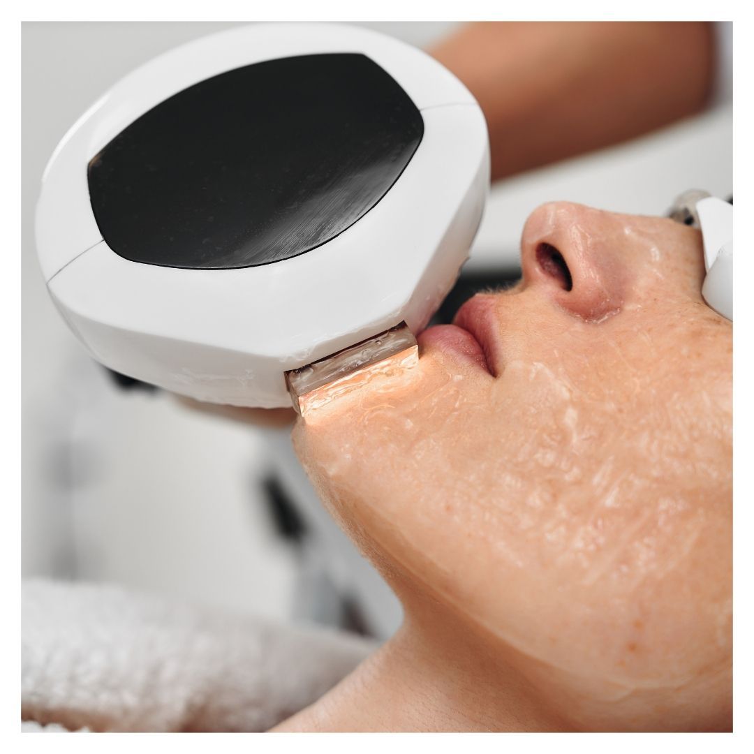 Top 4 Benefits of IPL for Age Spot Reduction - K2 Dermatology