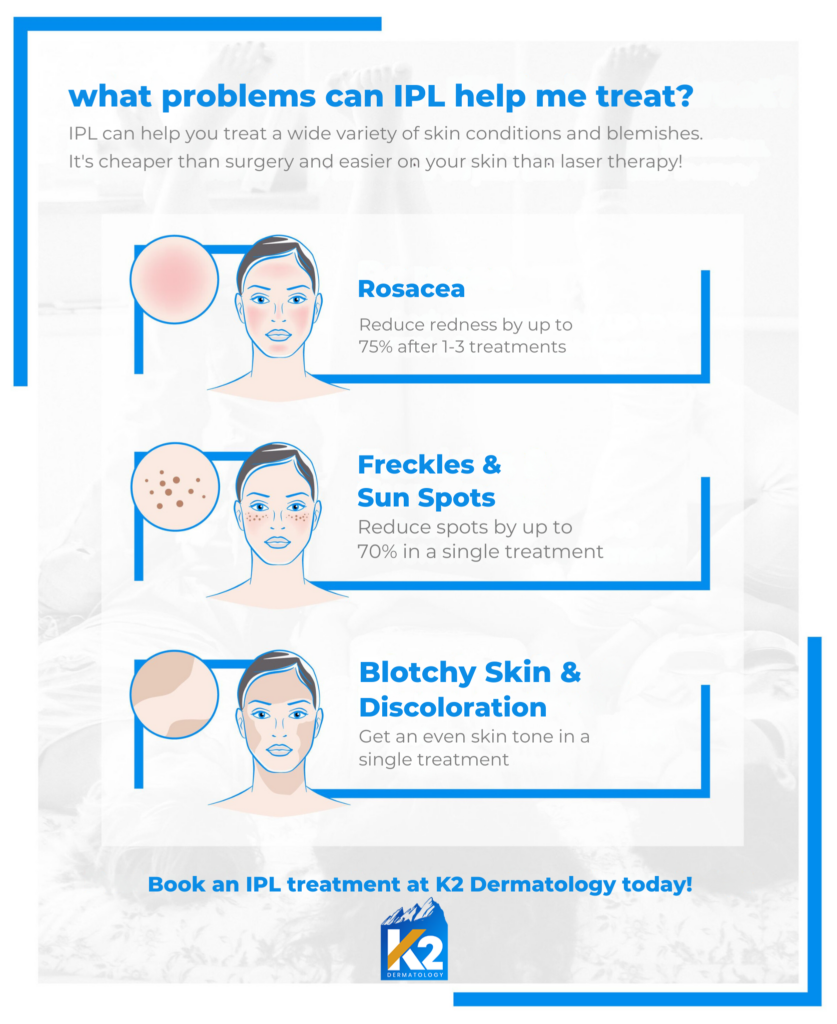 Laser/IPL in Boulder - K2 Dermatology