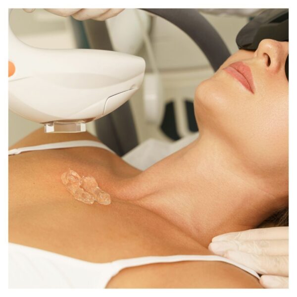 Top 4 Benefits of IPL for Age Spot Reduction - K2 Dermatology